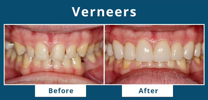 verneers5b - Bayside Dentistry